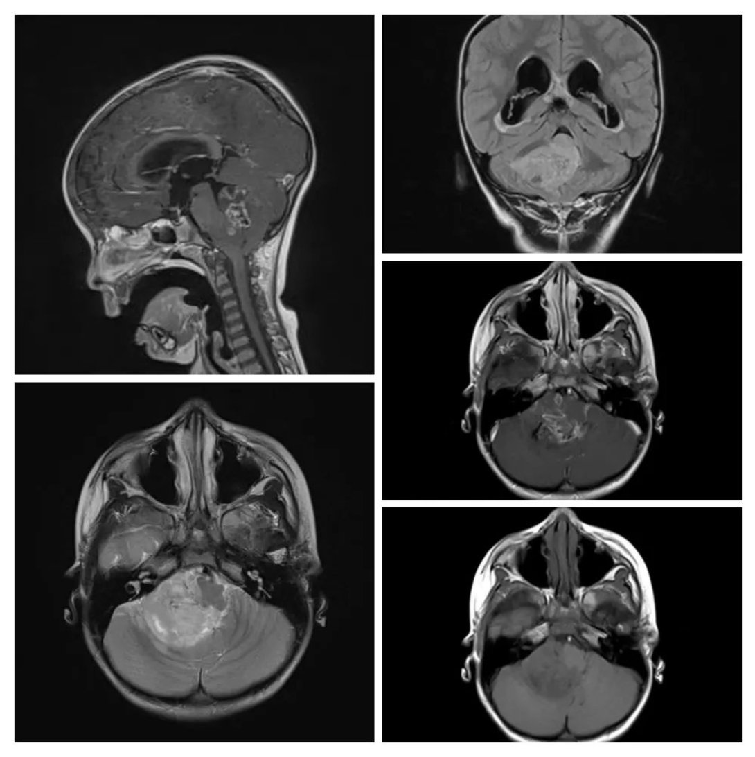 PANS – Pakistan Academy of Neurological Surgery