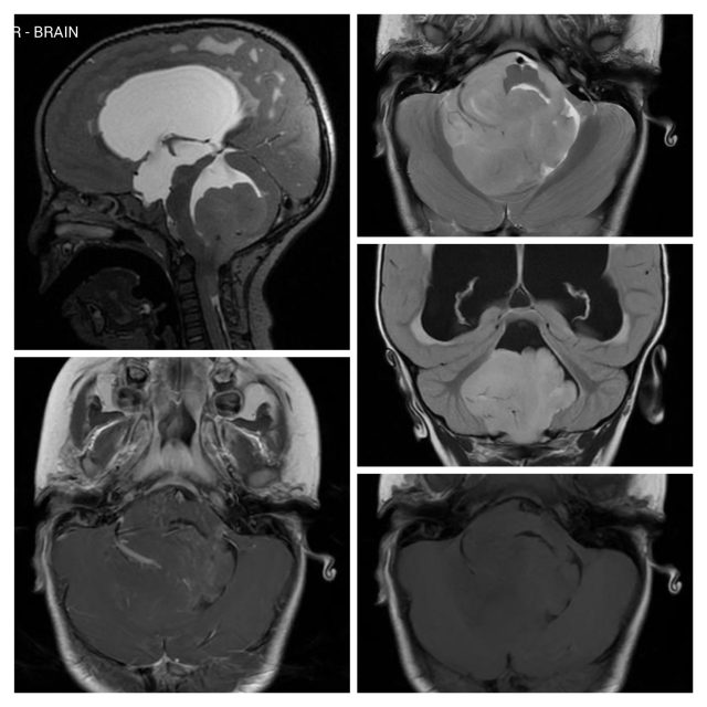 PANS – Pakistan Academy of Neurological Surgery